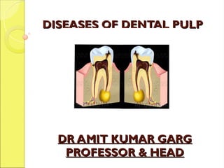 Disease of Dental Pulp powerpoint presentation | PPT