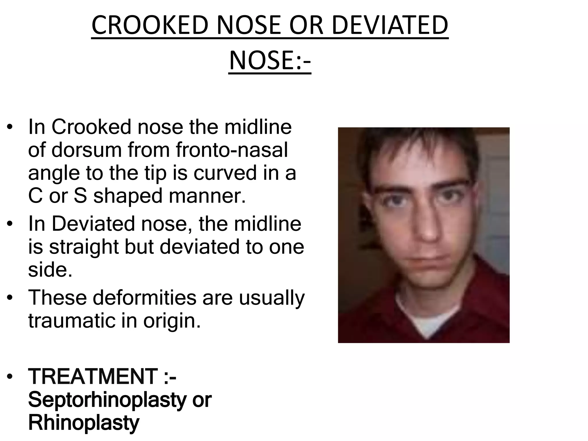 Disease of external nose deviated nasal septum, fb in nose 02.05.16, dr ...
