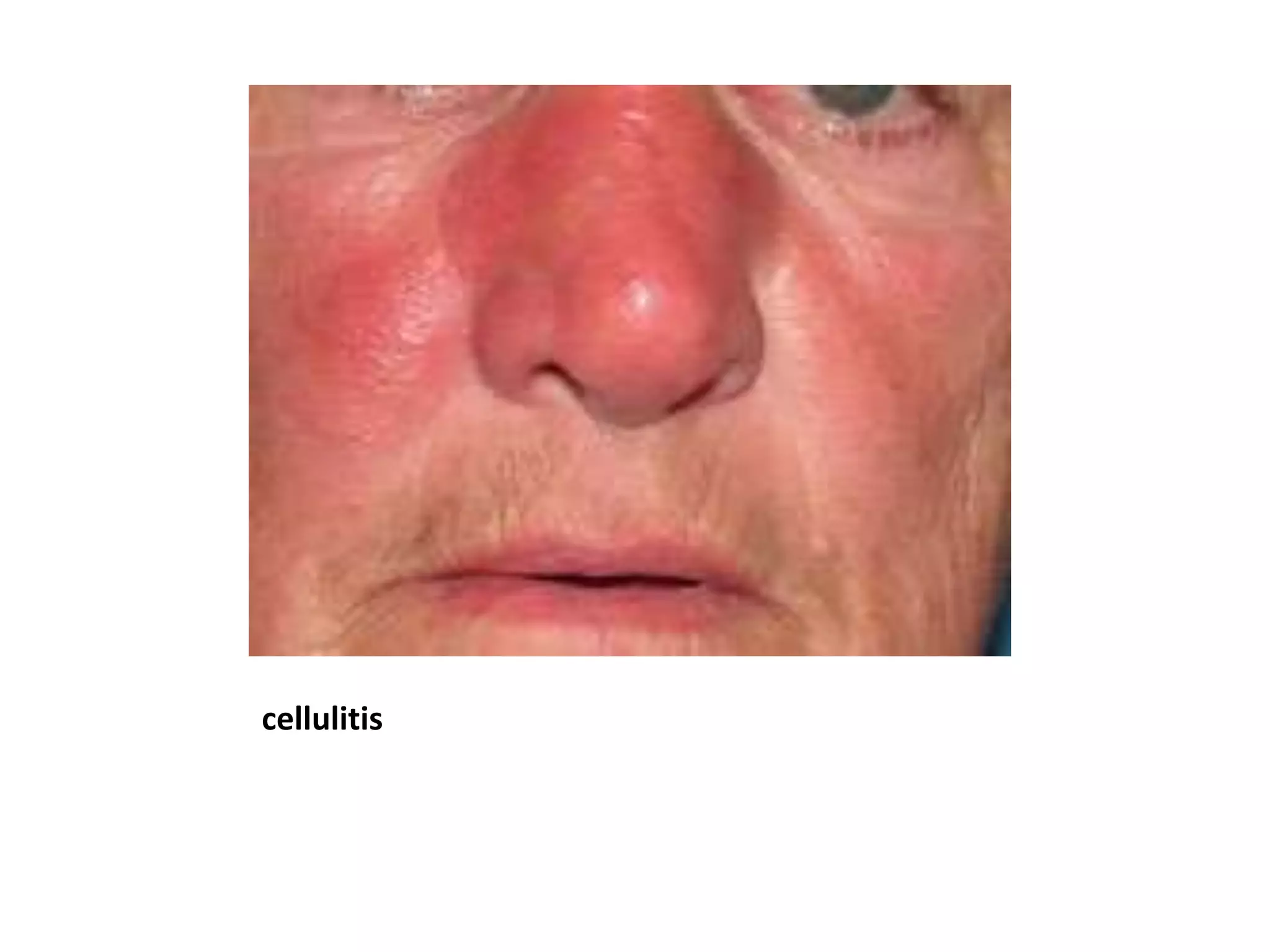 Disease of external nose deviated nasal septum, fb in nose 02.05.16, dr ...