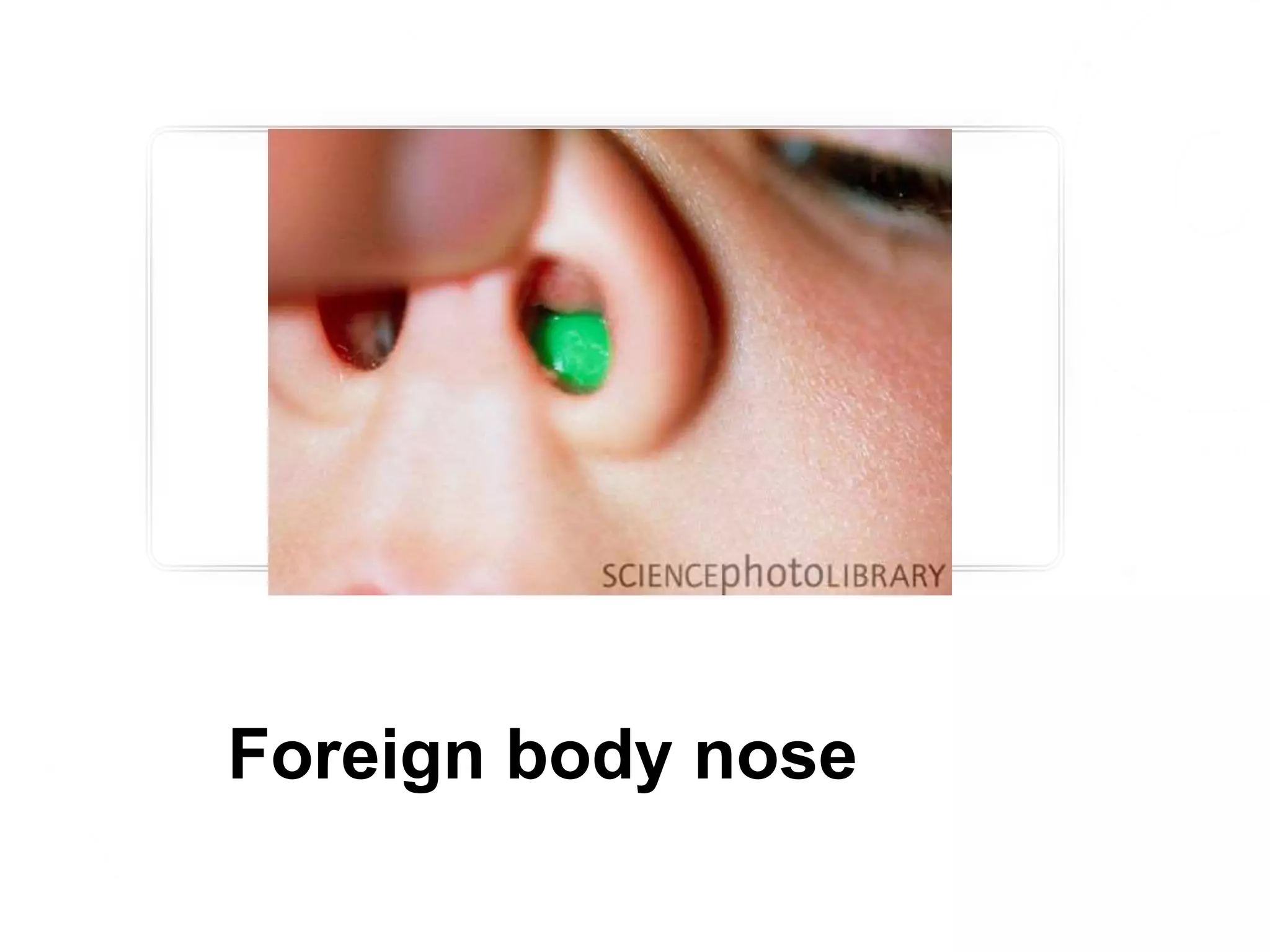 Disease of external nose deviated nasal septum, fb in nose 02.05.16, dr ...