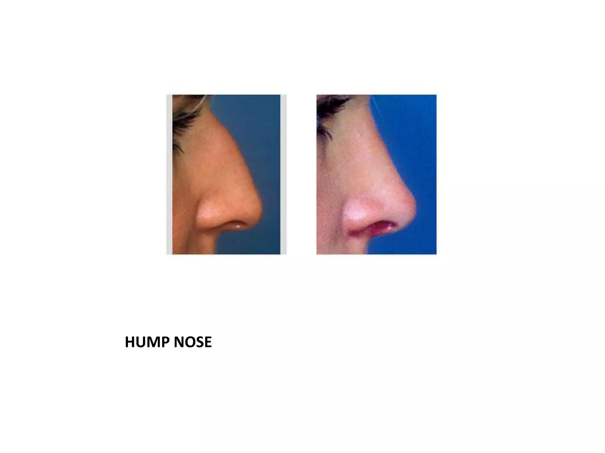 Disease of external nose deviated nasal septum, fb in nose 02.05.16, dr ...