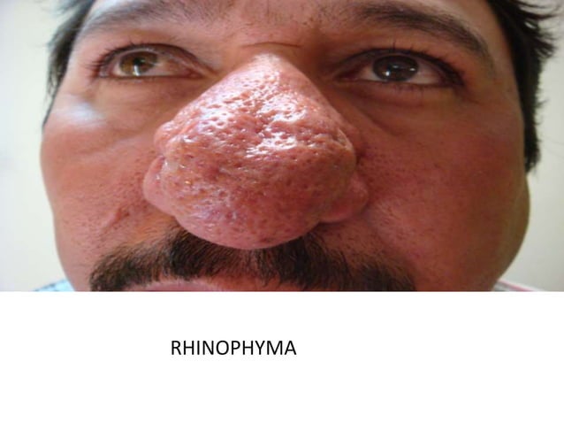 Disease of external nose deviated nasal septum, fb in nose 02.05.16, dr ...