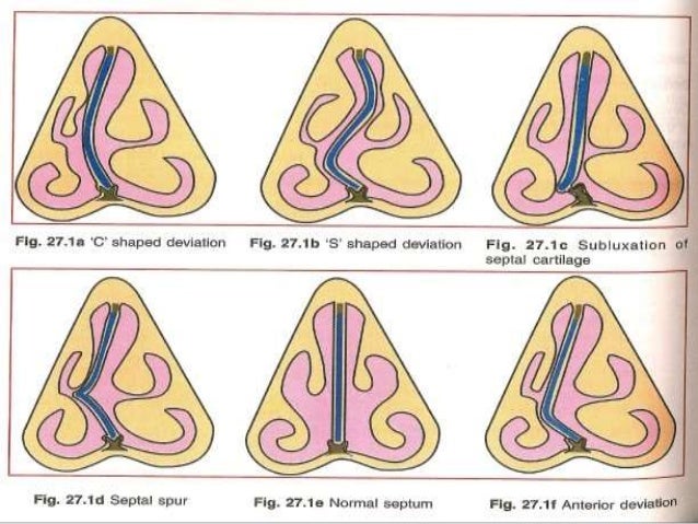 Disease of external nose deviated nasal septum, fb in nose 02.05.16,…