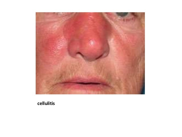 Cellulitis On Nose