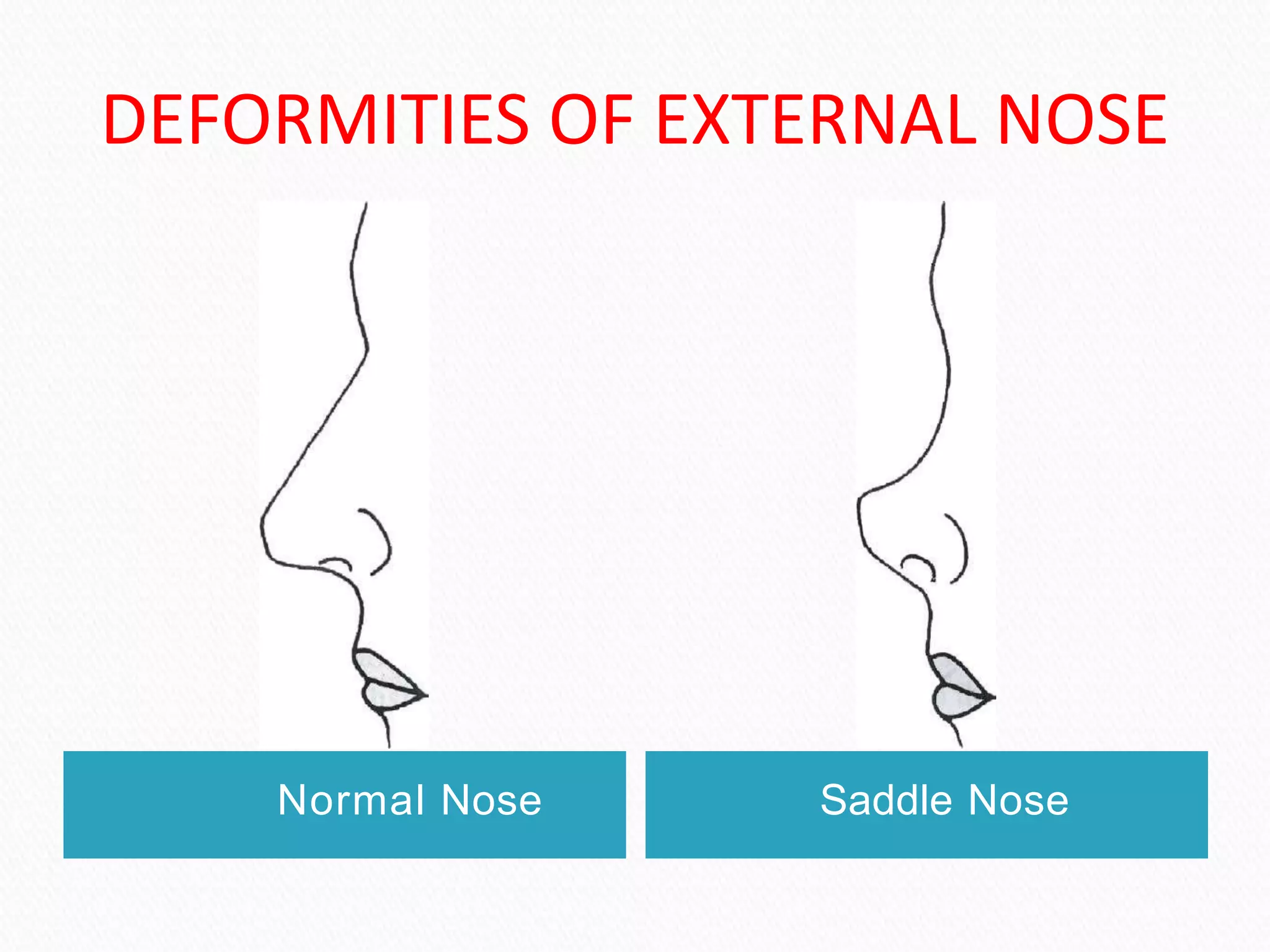 Disease of External Nose & Nasal Cavity | PPTX