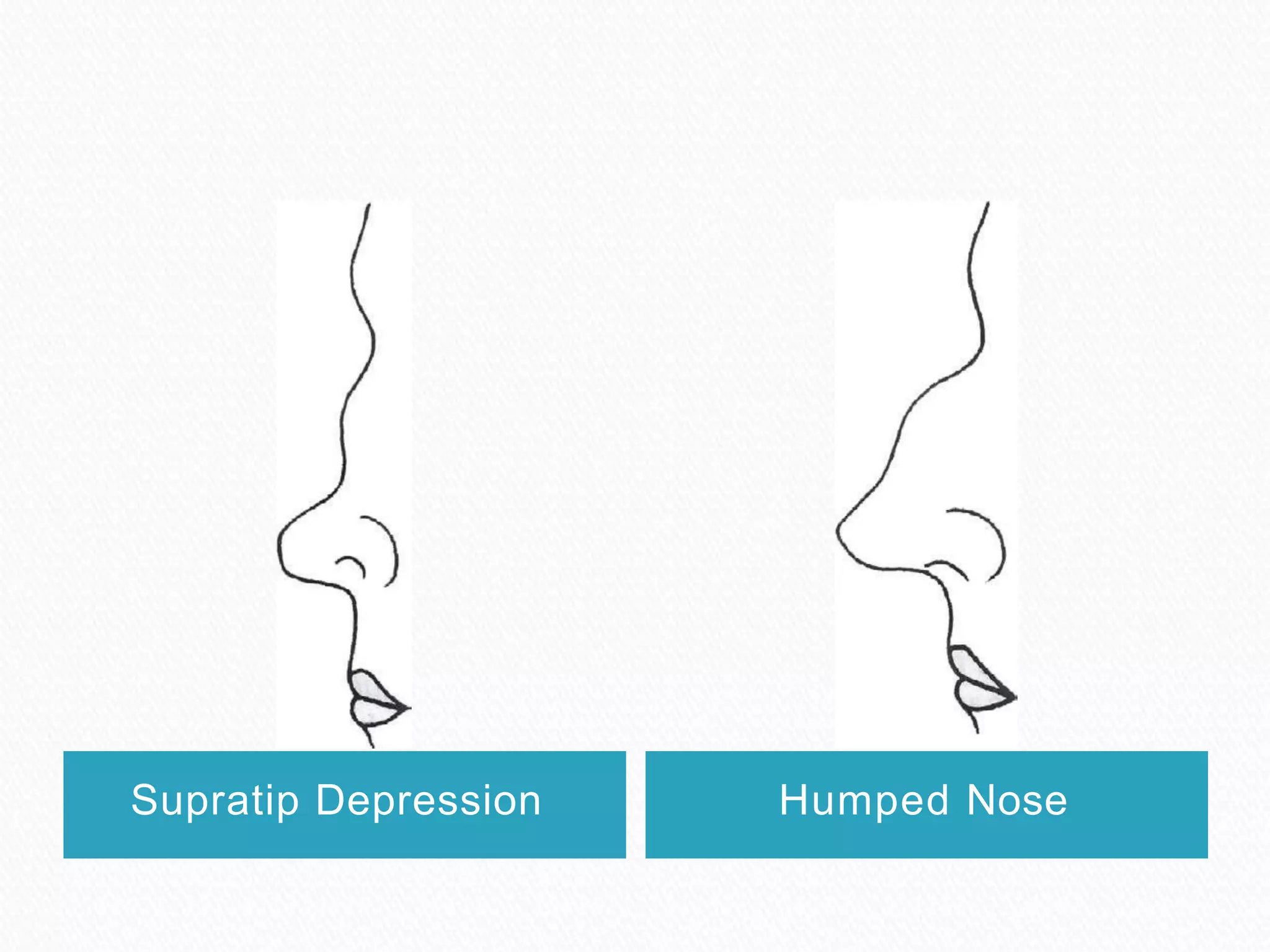 Disease of External Nose & Nasal Cavity | PPTX