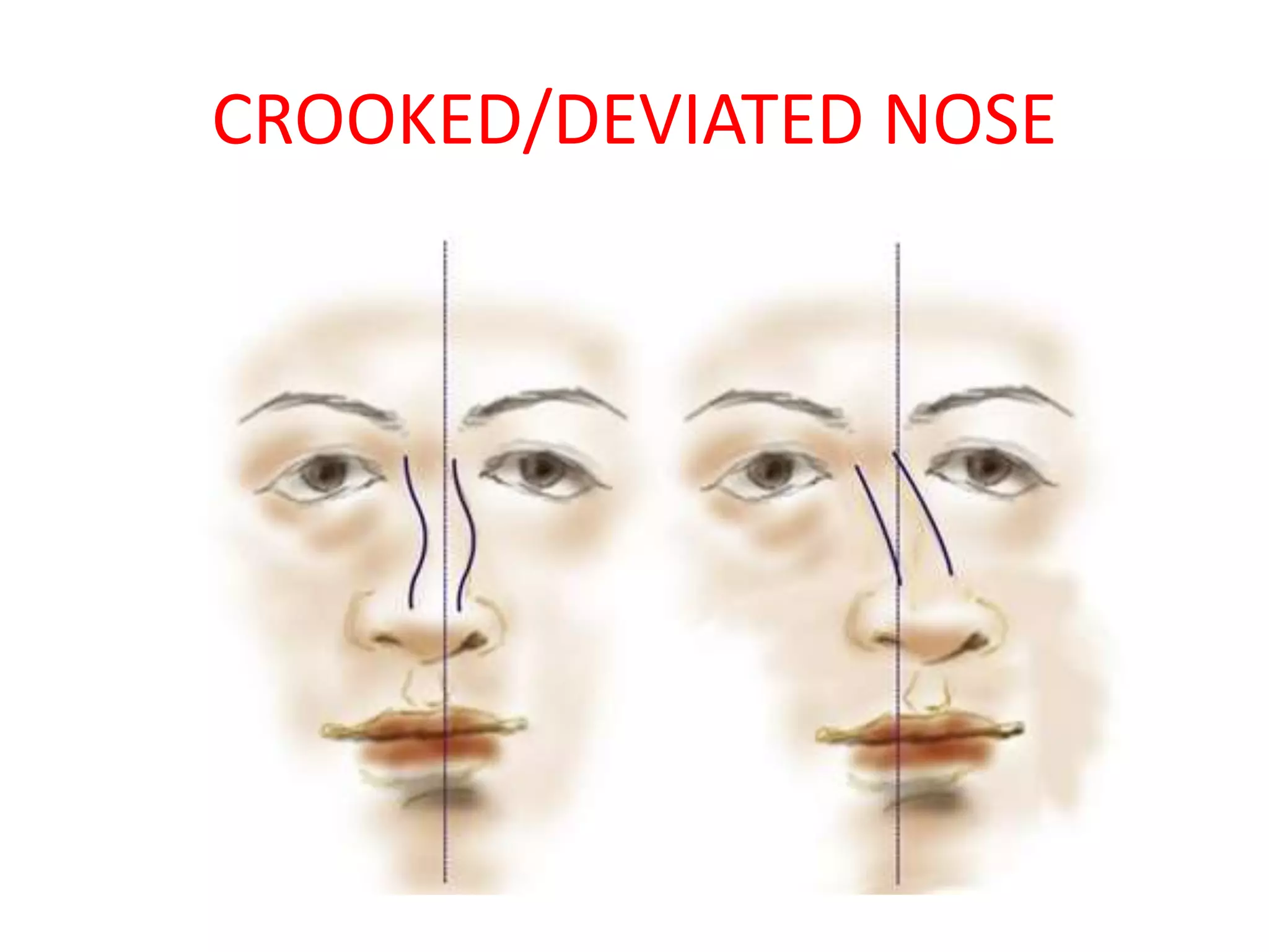 Disease of External Nose & Nasal Cavity | PPTX