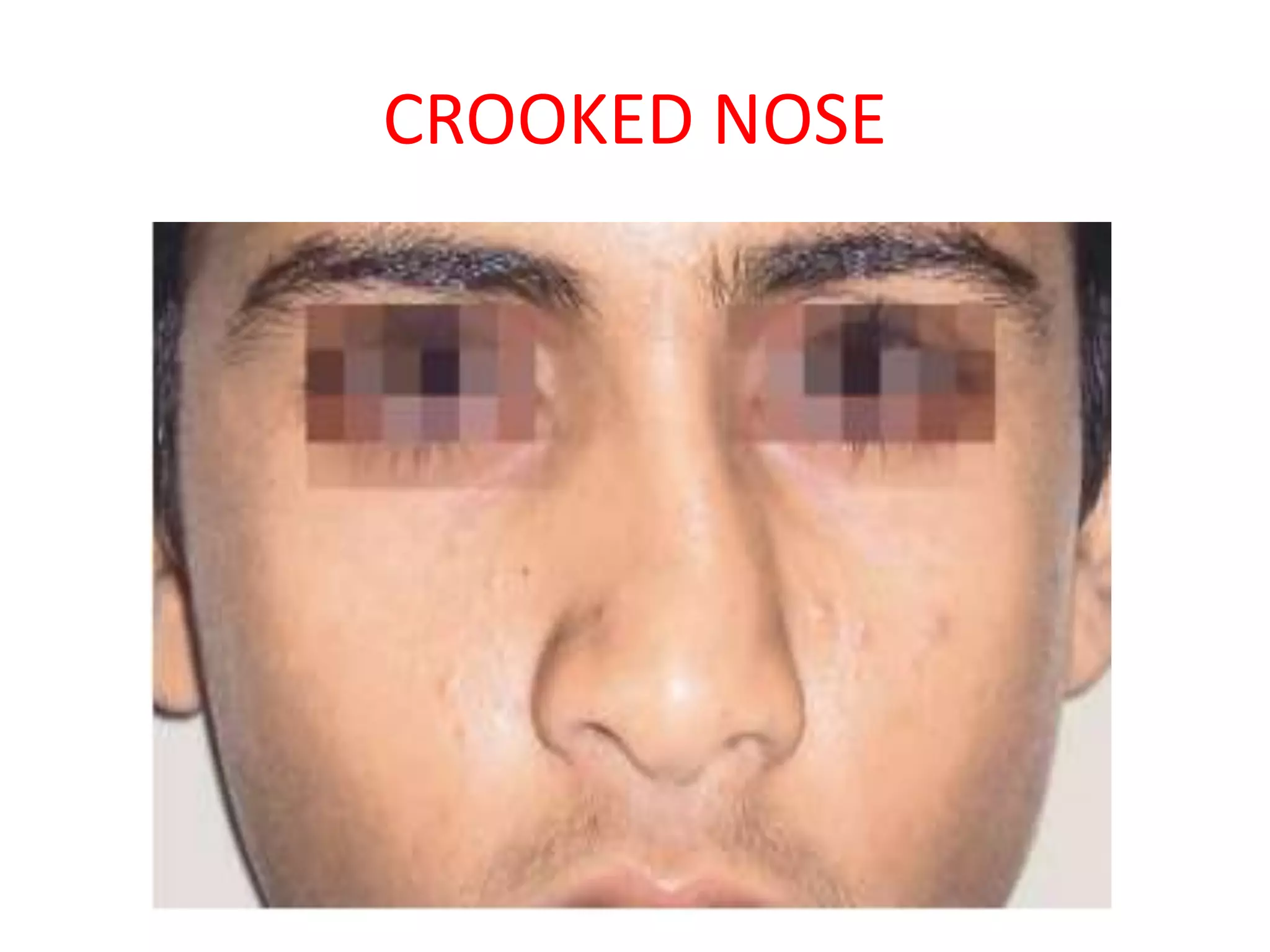 Disease of External Nose & Nasal Cavity | PPTX