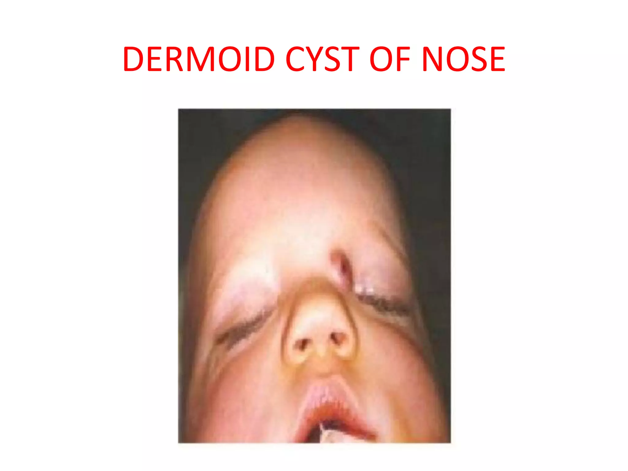 Disease of External Nose & Nasal Cavity | PPTX