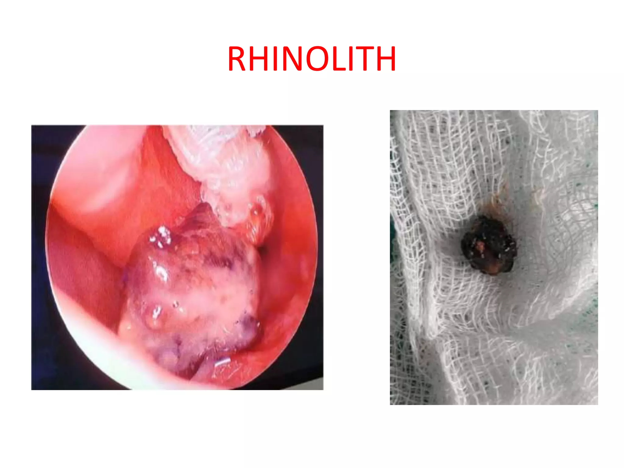Disease of External Nose & Nasal Cavity | PPTX
