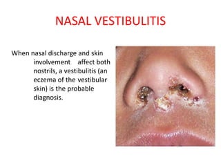 Disease of External Nose & Nasal Cavity | PPTX
