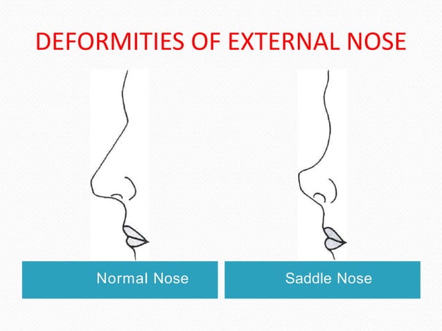 Disease of External Nose & Nasal Cavity | PPTX