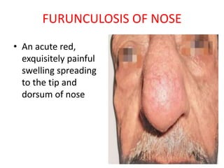 Disease of External Nose Nasal Cavity PPT