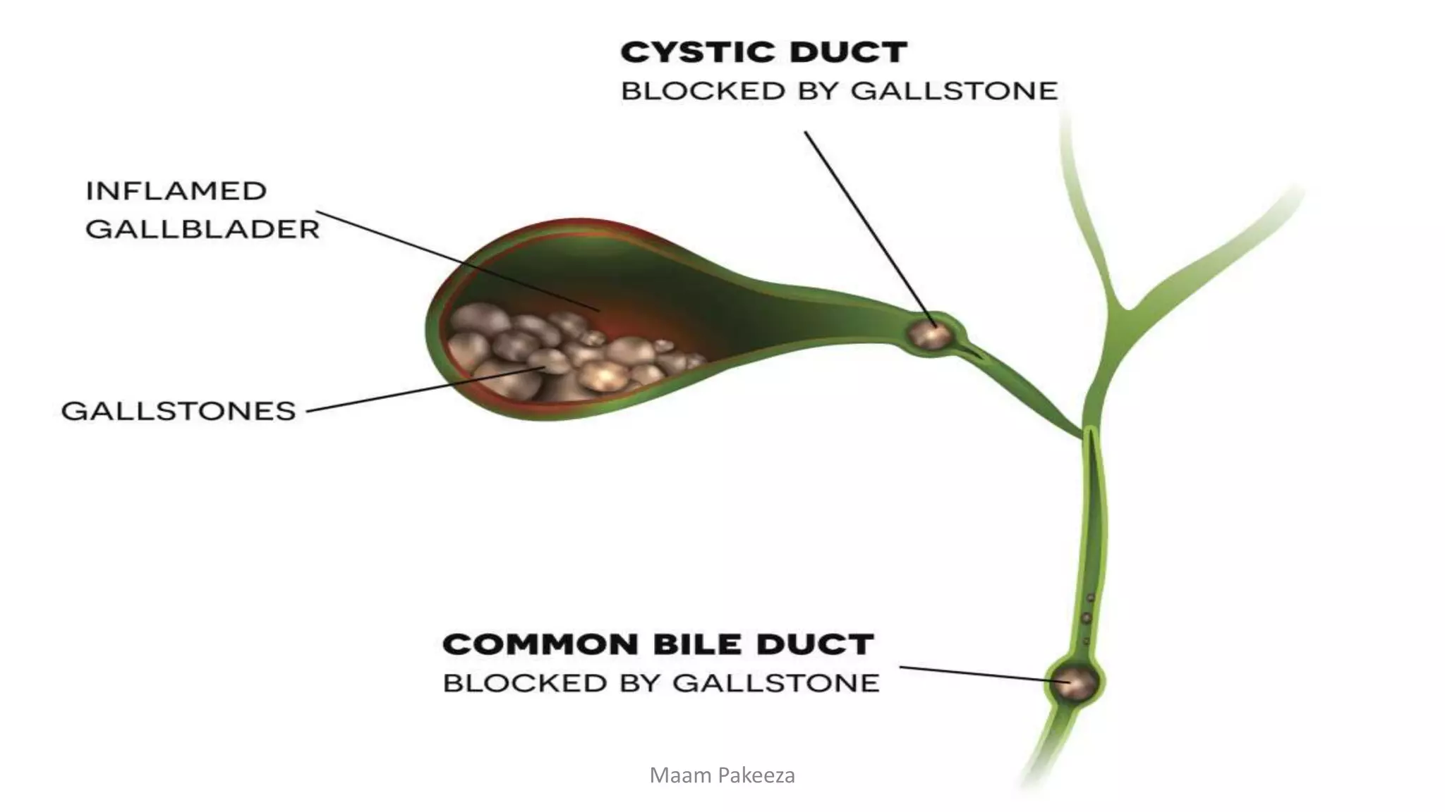 Disease of gall bladder | PPTX