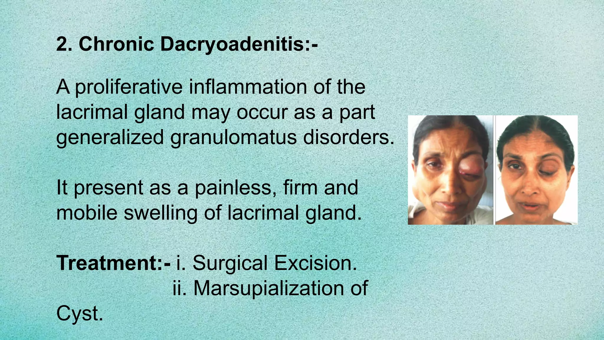 Disease of lacrimal apperatus.ppt by Optom. Saharukh Alam | PDF