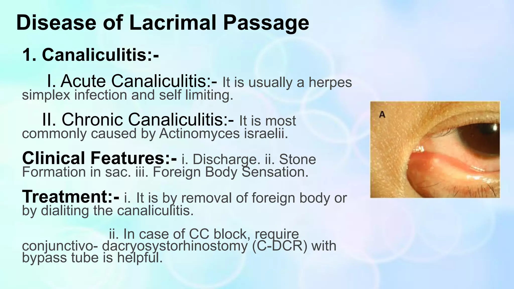 Disease of lacrimal apperatus.ppt by Optom. Saharukh Alam | PDF