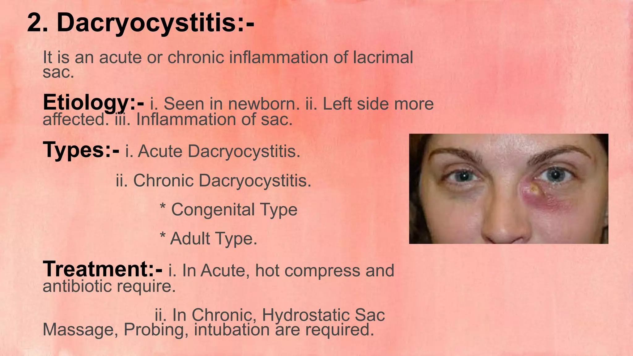 Disease of lacrimal apperatus.ppt by Optom. Saharukh Alam | PDF