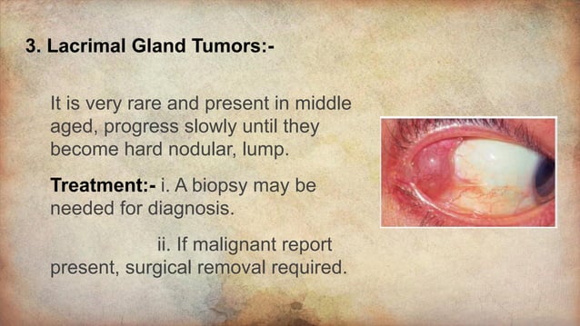 Disease of lacrimal apperatus.ppt by Optom. Saharukh Alam | PPT