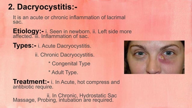 Disease of lacrimal apperatus.ppt by Optom. Saharukh Alam | PPT