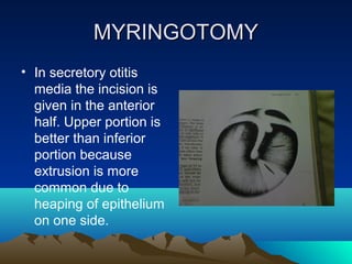 Disease of middle ear | PPT