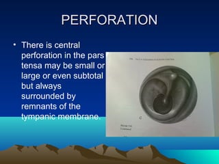 Disease of middle ear | PPT