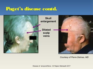 Disease of temporal bone.ppt new copy | PPT