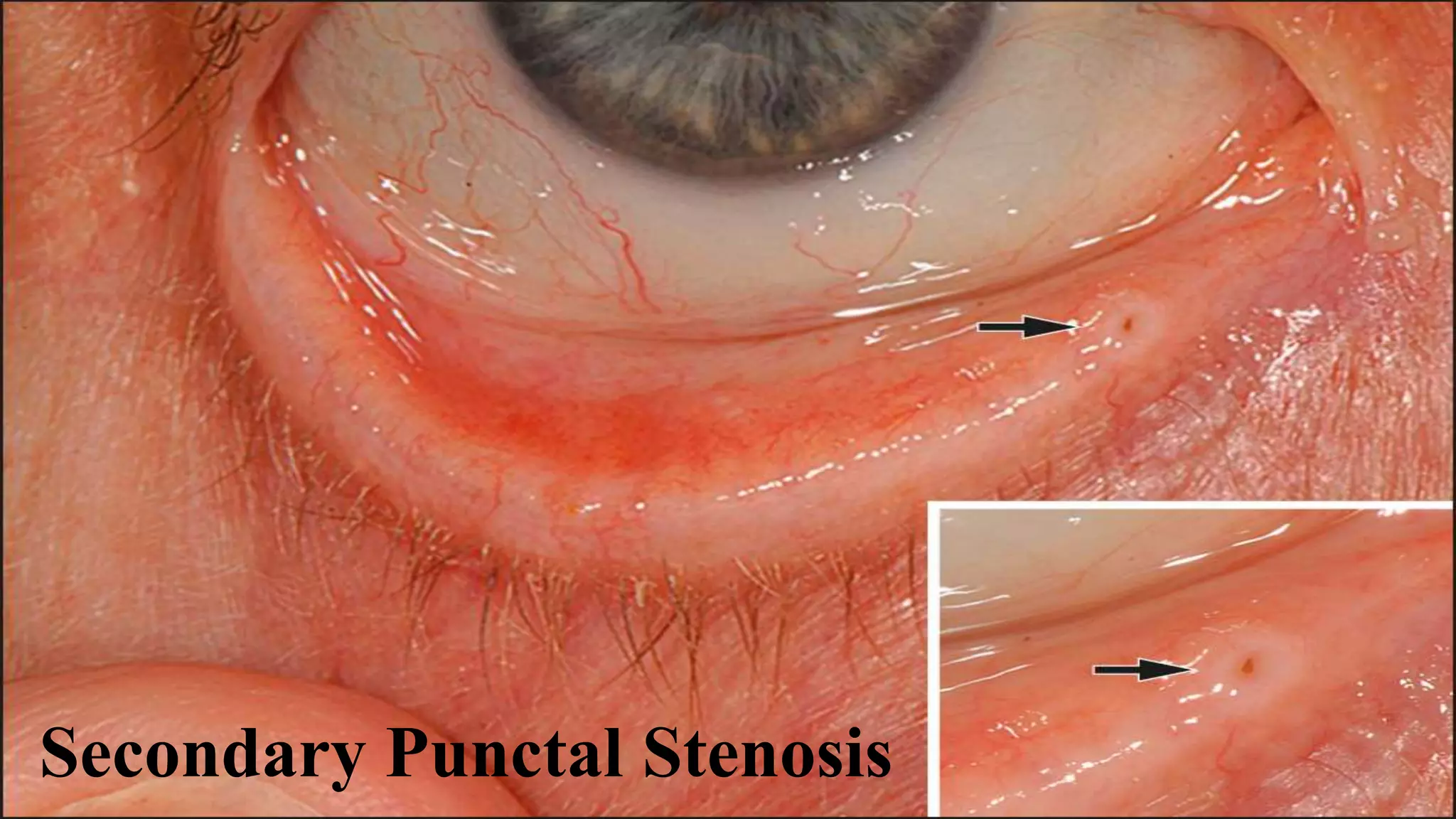 Disease of the lacrimal apparatus | PPTX