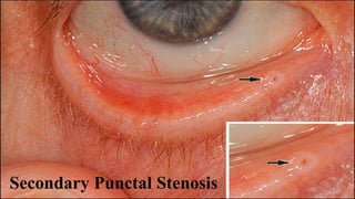 Disease of the lacrimal apparatus | PPTX