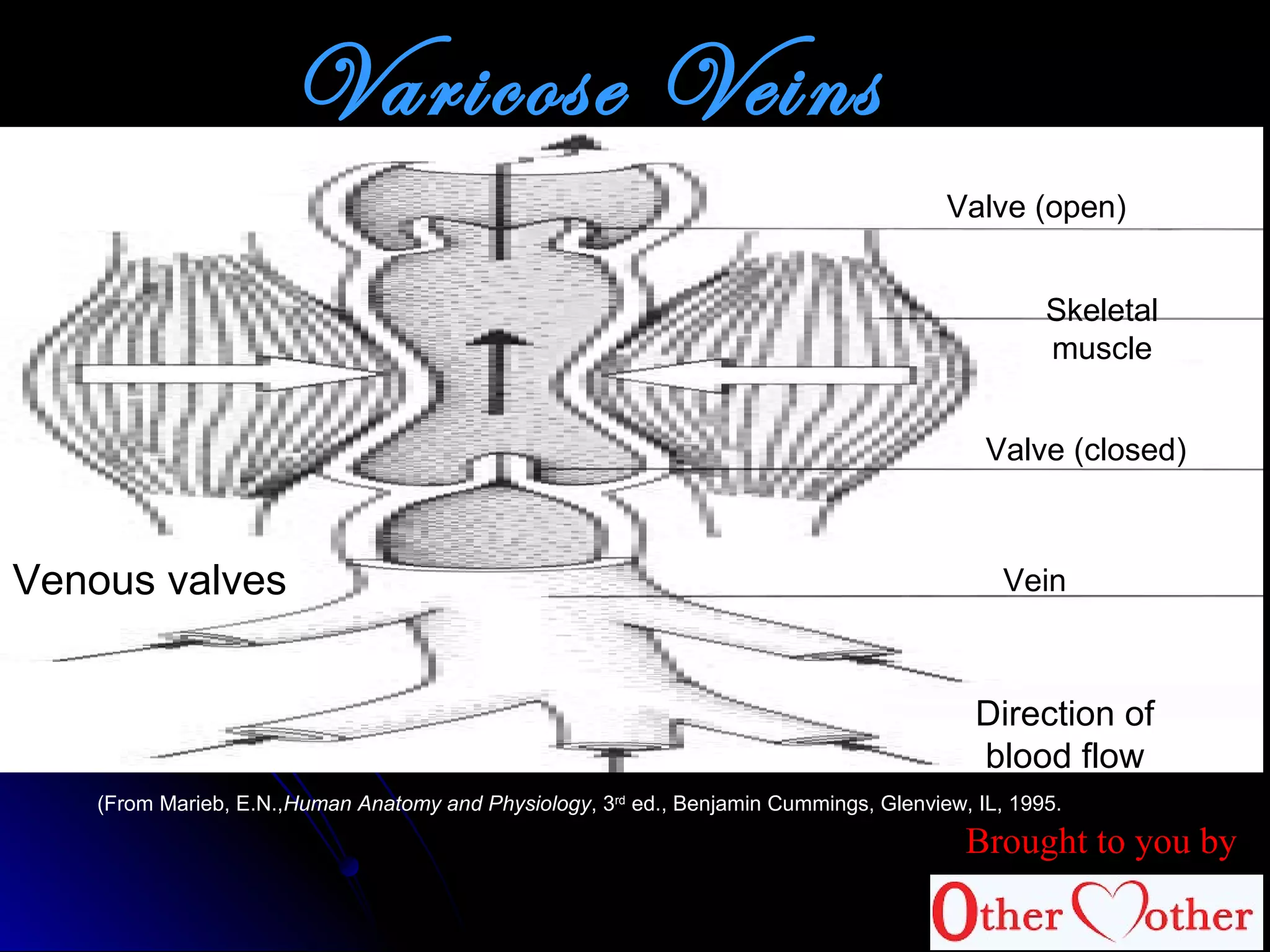 Disease of the veins | PPT