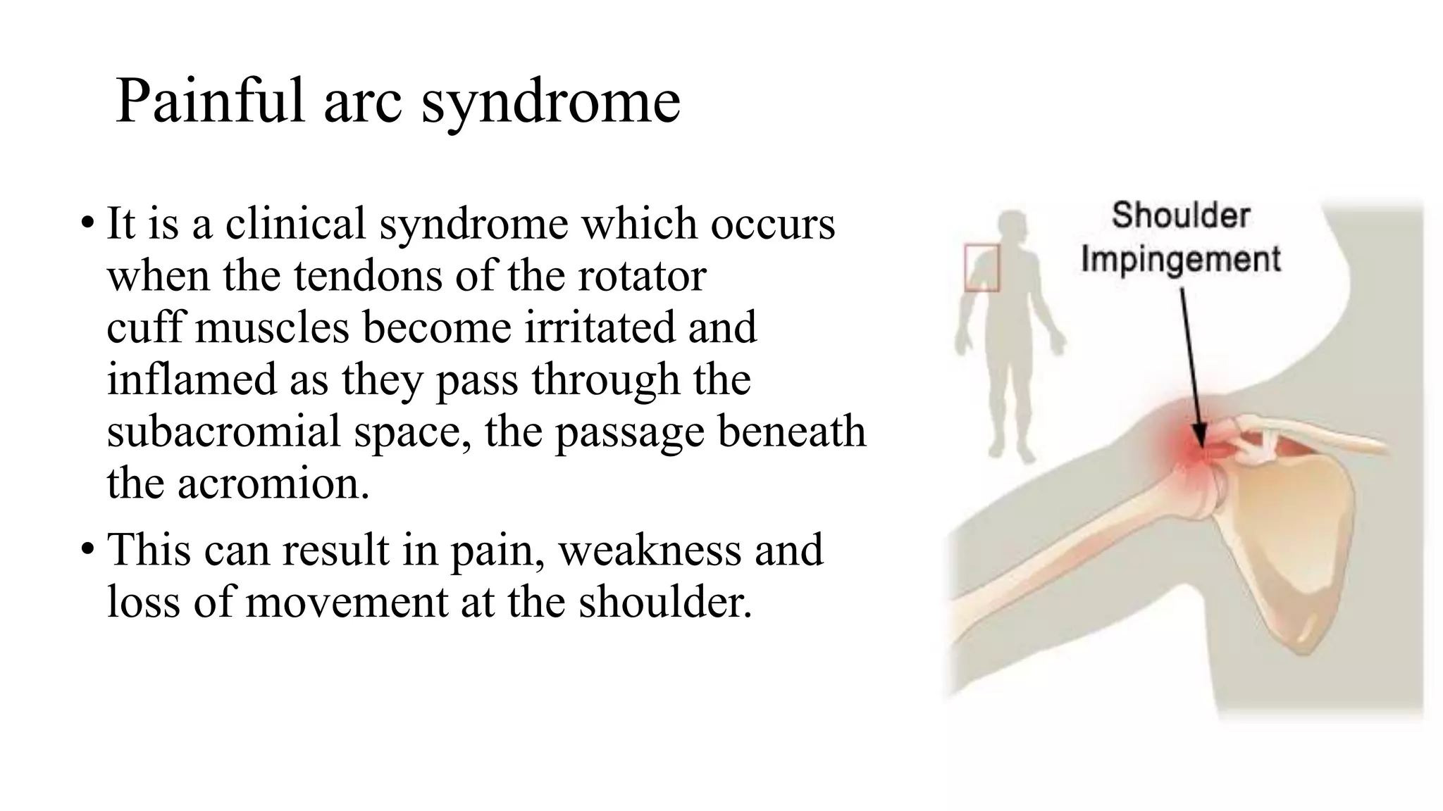 Diseases Low back pain. Painful arc syndrome. Fasciitis. Leprosy. | PPTX