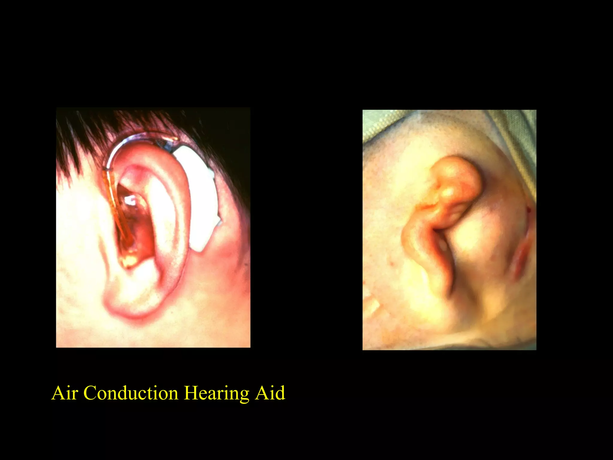 Diseases of external ear ug dr.s.vijaya sundaram 01.02.16