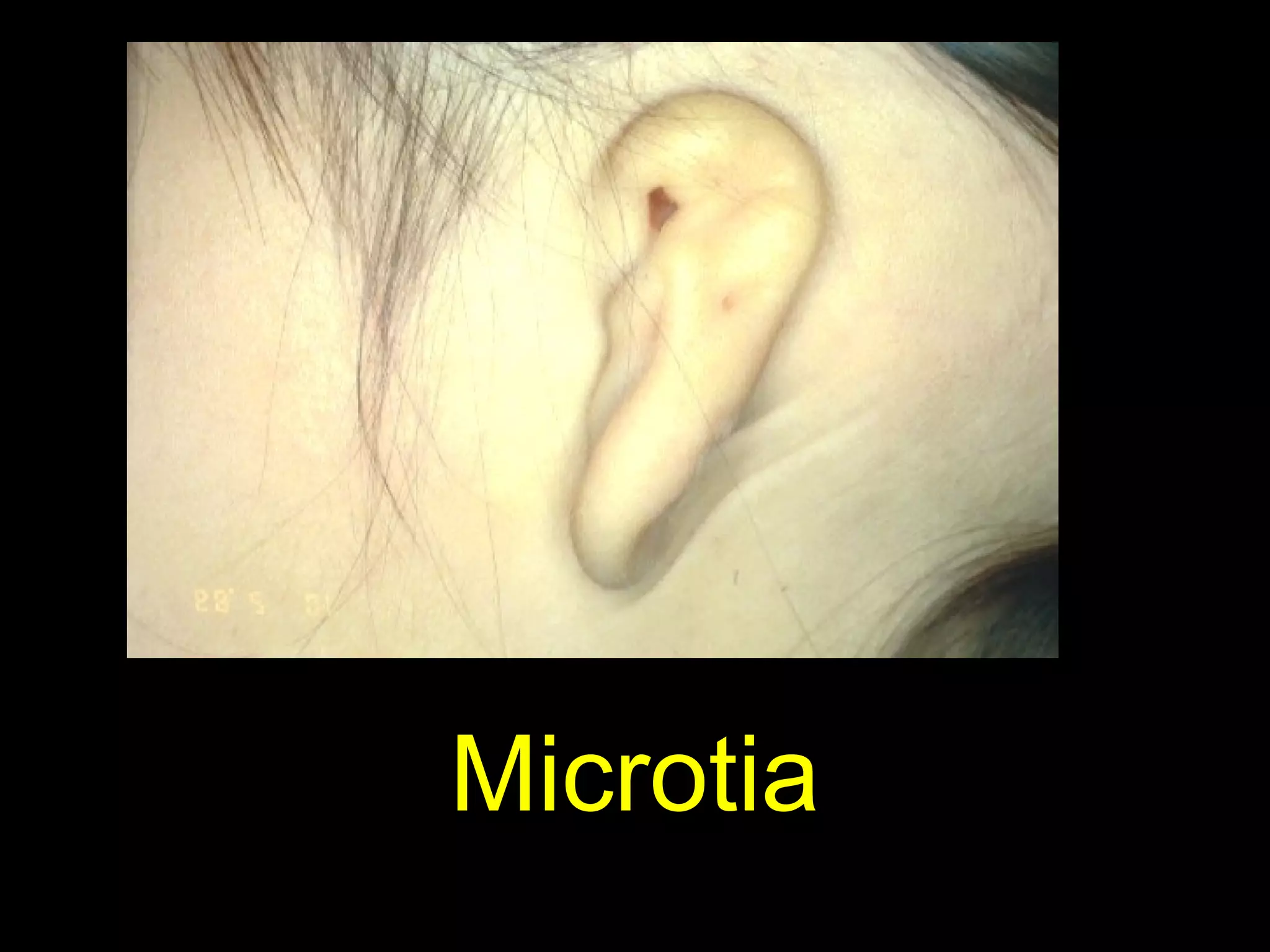 Diseases of external ear ug dr.s.vijaya sundaram 01.02.16