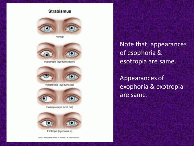 Diseases of ocular motility