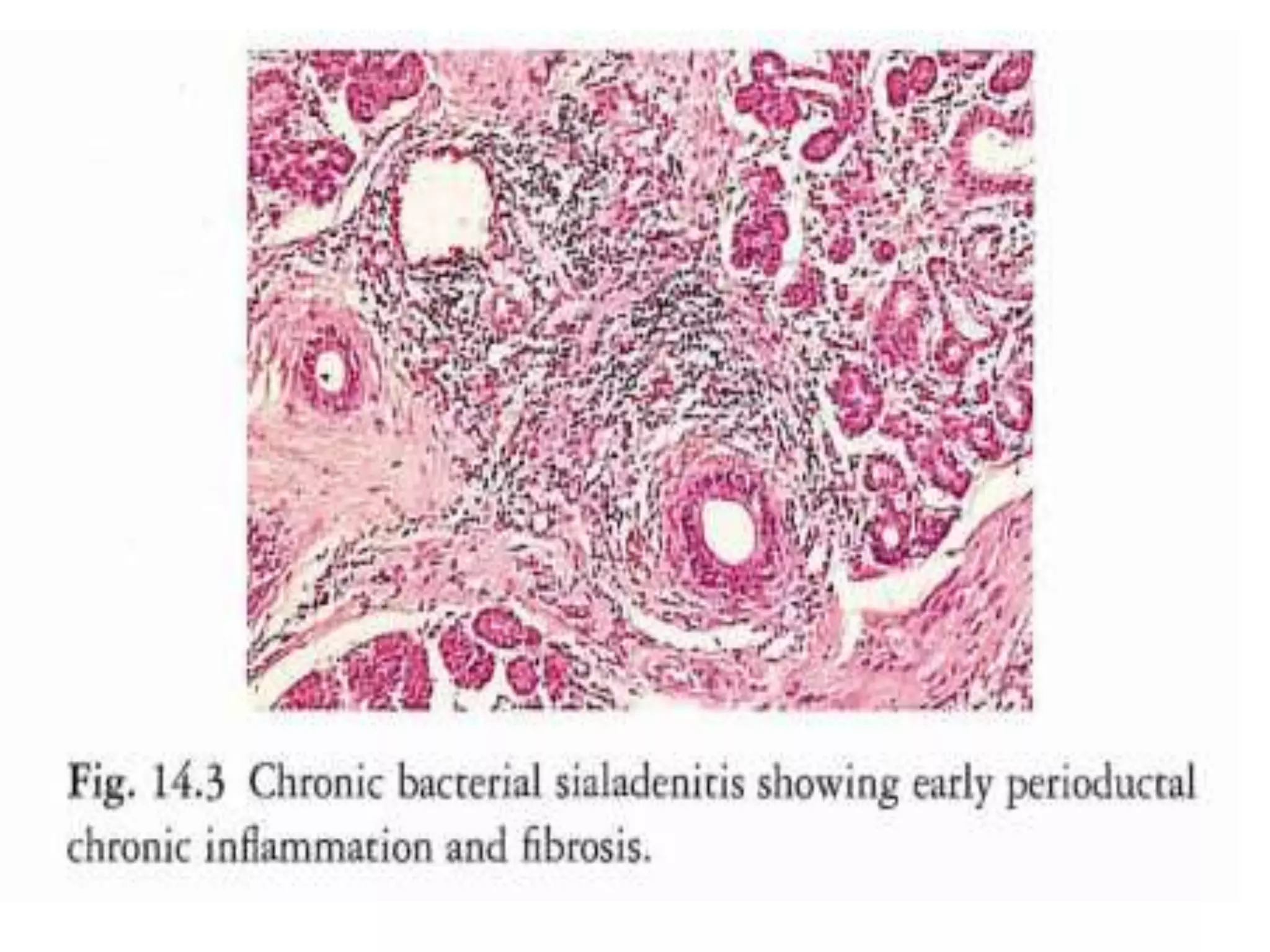 Diseases of-salivary-glands | PPSX
