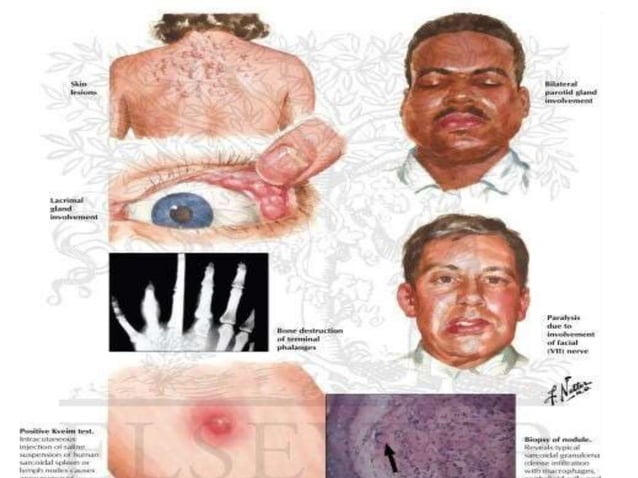 Diseases of-salivary-glands | PPSX
