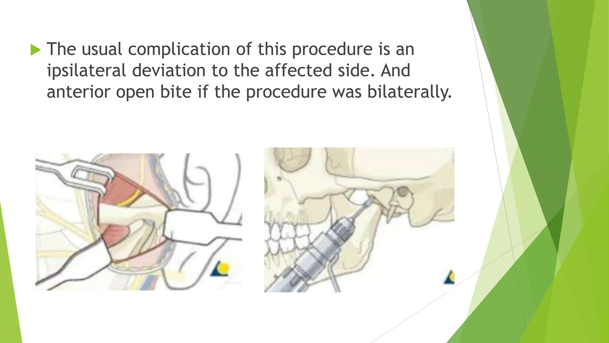 Classification of Diseases of TMJ and TMJ ankylosis in detail | PPTX