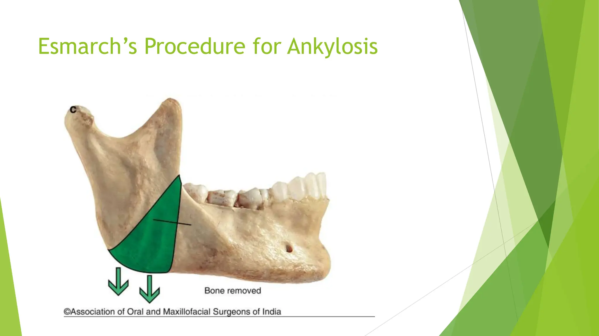 Classification of Diseases of TMJ and TMJ ankylosis in detail | PPTX