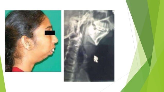 Classification of Diseases of TMJ and TMJ ankylosis in detail | PPTX