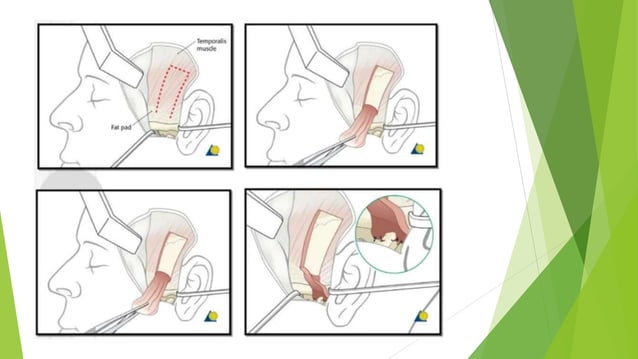 Classification of Diseases of TMJ and TMJ ankylosis in detail | PPTX