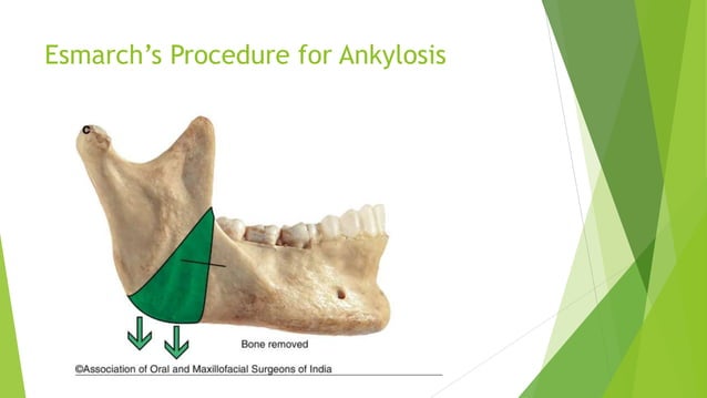 Classification of Diseases of TMJ and TMJ ankylosis in detail | PPTX