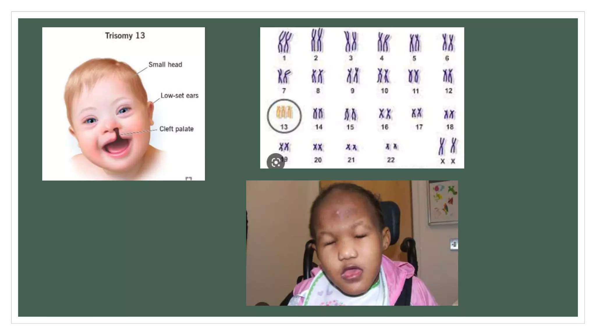 Diseases and abnormalities caused by mutation.pptx