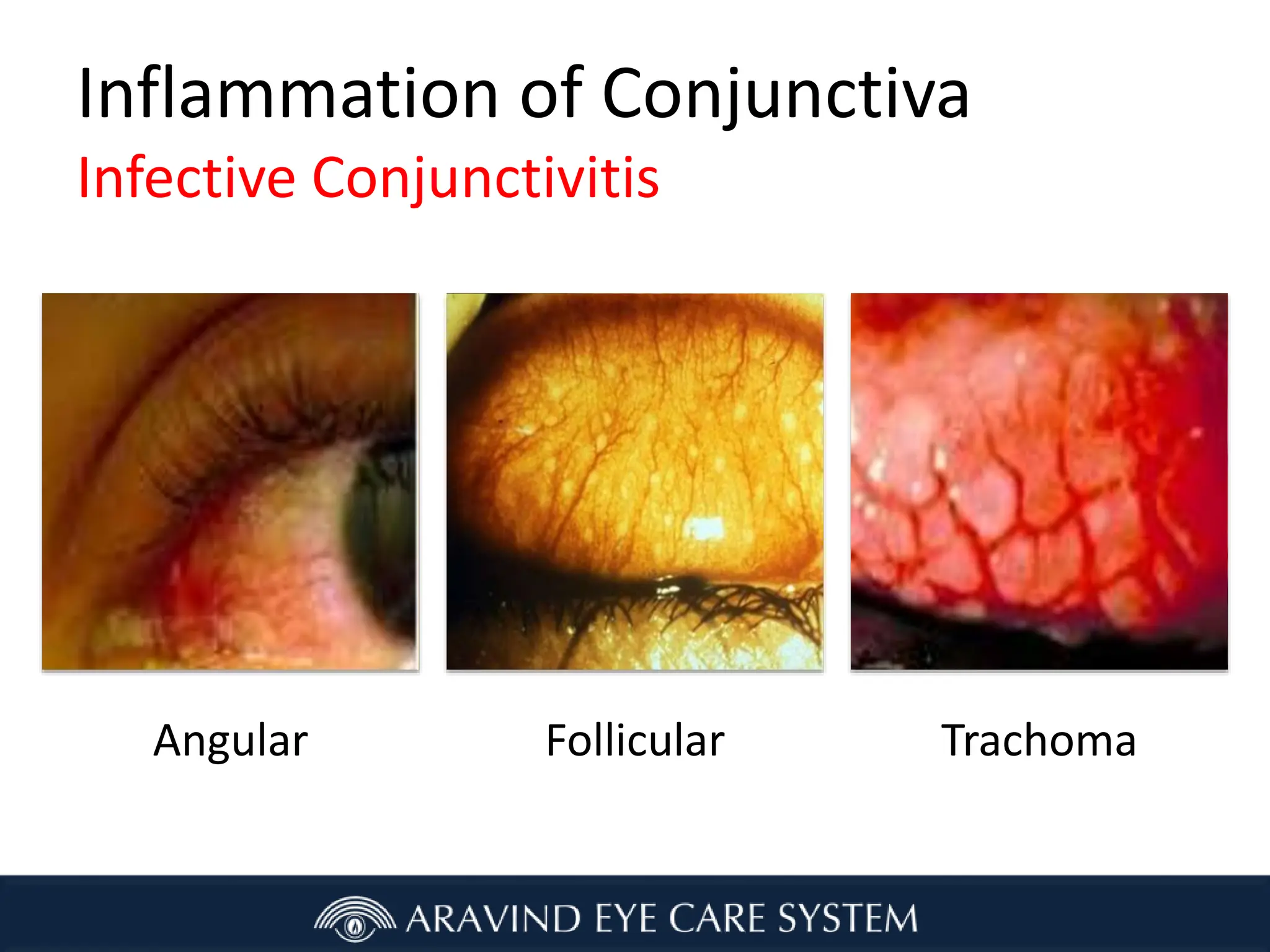 Diseases and Disorders of Conjunctiva.pptx
