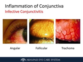 Diseases and Disorders of Conjunctiva.pptx | Eye and Vision Conditions ...