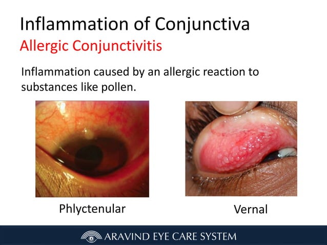 Diseases and Disorders of Conjunctiva.pptx