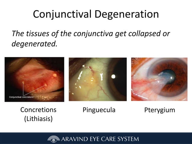 Diseases and Disorders of Conjunctiva.pptx