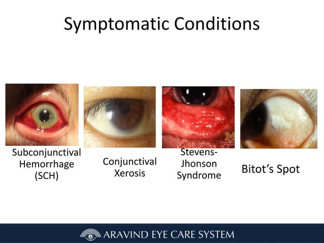 Diseases and Disorders of Conjunctiva.pptx
