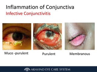 Diseases and Disorders of Conjunctiva.pptx | Eye and Vision Conditions ...