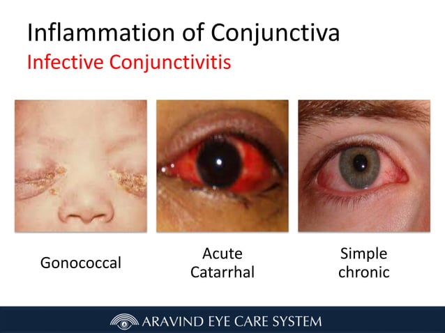 Diseases and Disorders of Conjunctiva.pptx