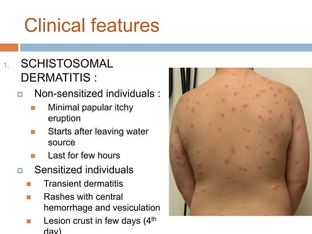 Diseases caused by worms and parasites | PPTX | Skin and Dermatology ...