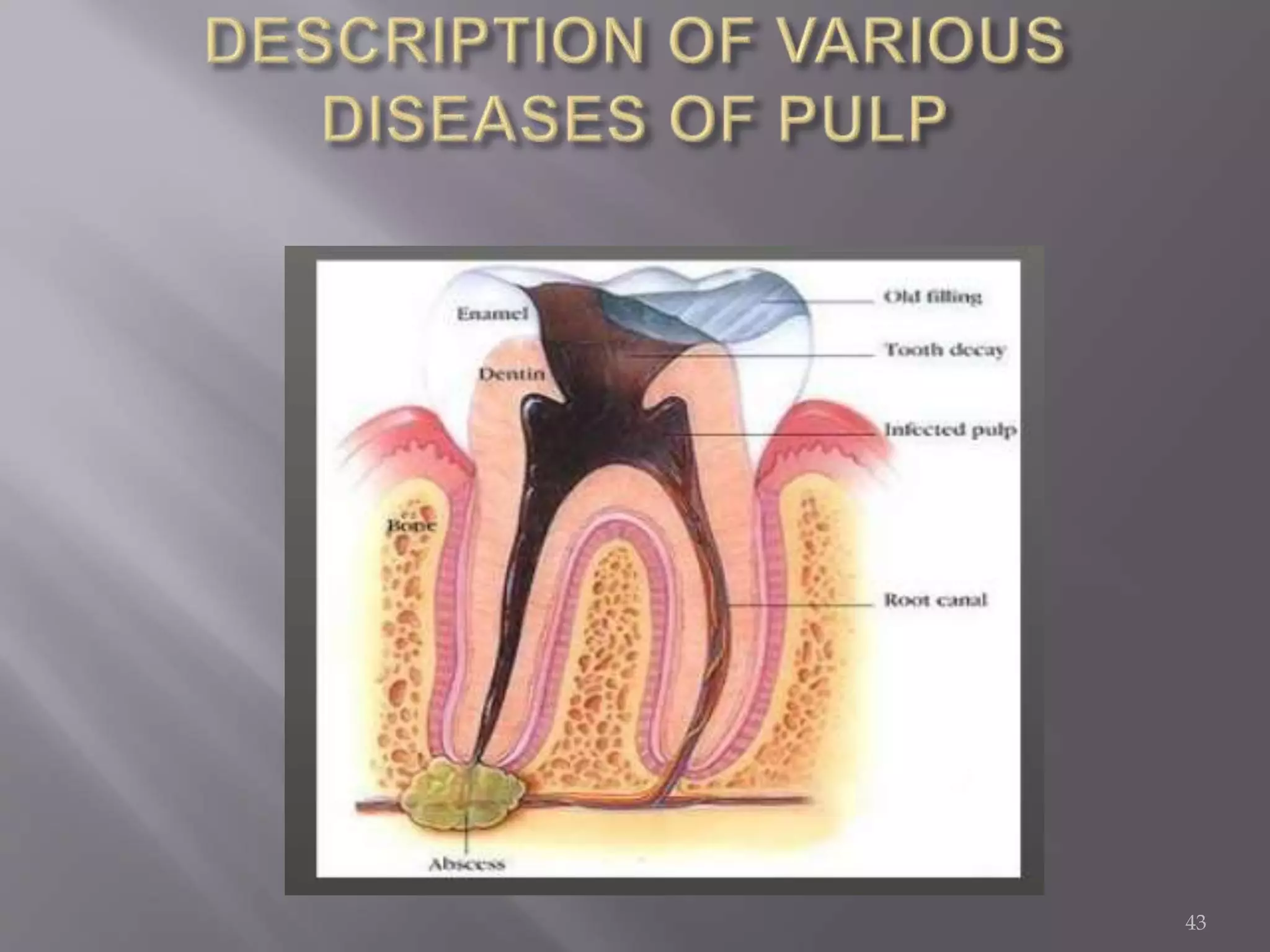 Diseases for pulp and periapical tissues | PPTX
